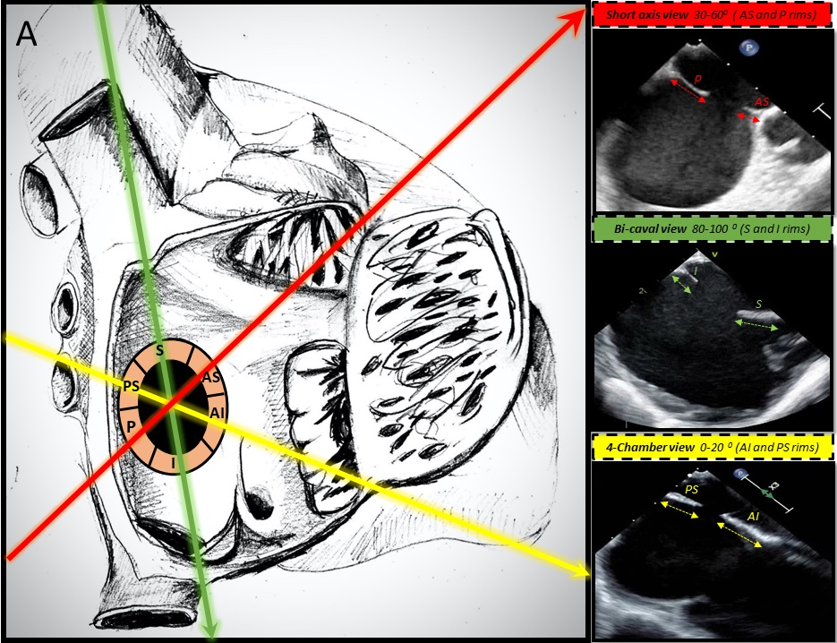 Single Tertiary Center Experience Using Gore Cardioform Atrial Septal